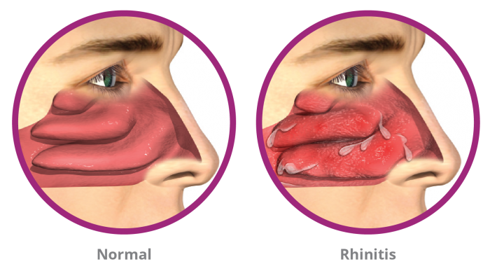 Joplin Ear Nose And Throat Otolaryngologists Rhinitis